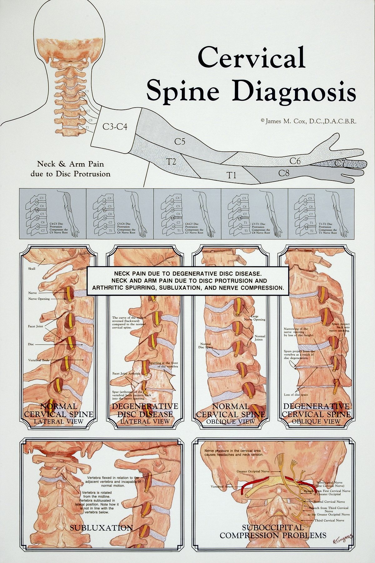 Cervical Spine Diagnosis Poster Cervical Spine Diagnosis Poster